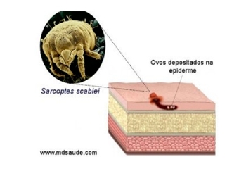 O que é escabiose? - Júlia Mendes - Clínica de Pele Derma Life